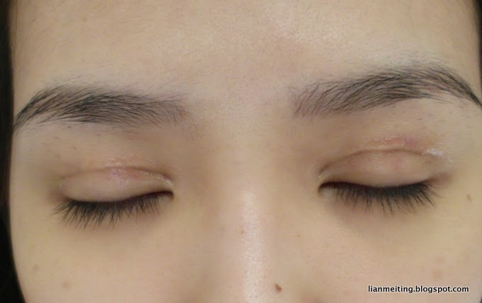 L I A N M E I T I N G : My double eyelid surgery experience