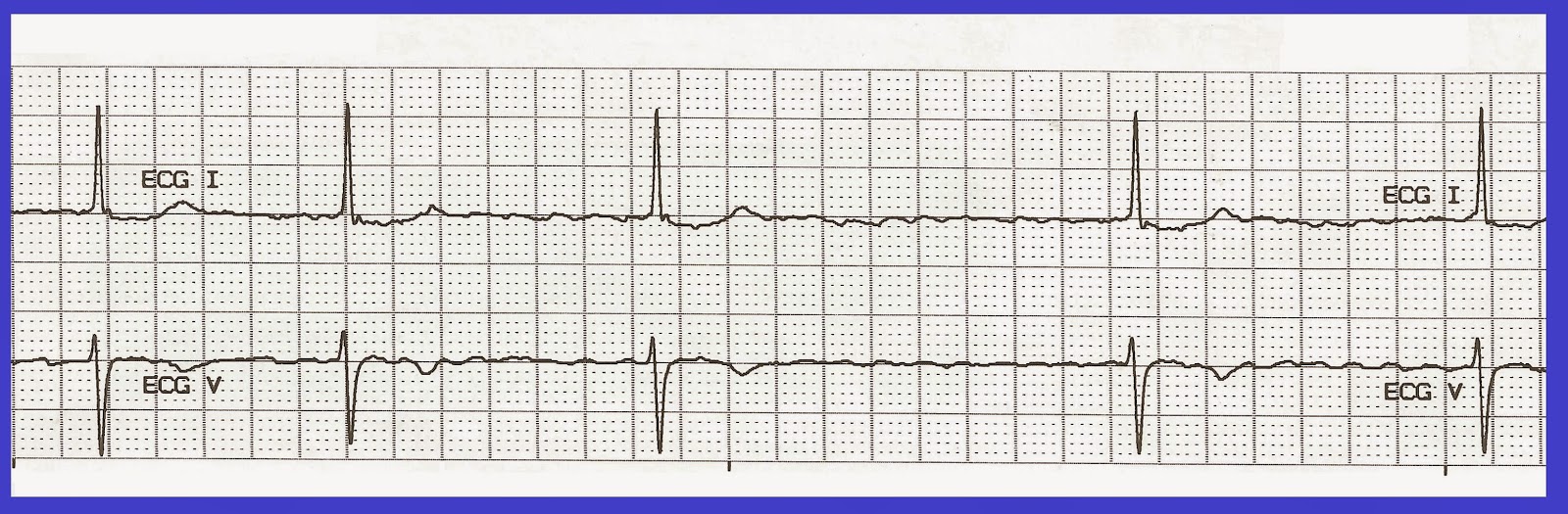 Float Nurse: EKG Rhythm Quiz 267