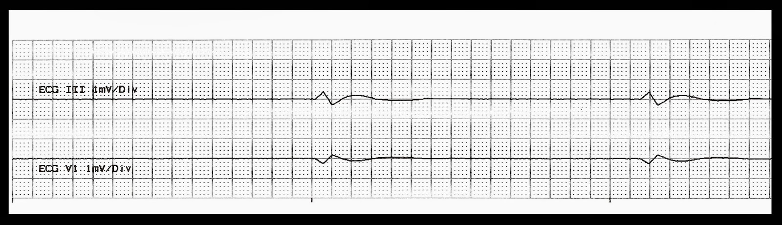 Float Nurse: Basic EKG Rhythm Test 18