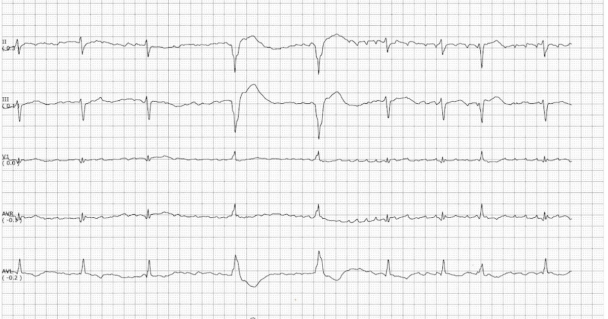 Float Nurse: Atrial fibrillation with some ventricular escape beats
