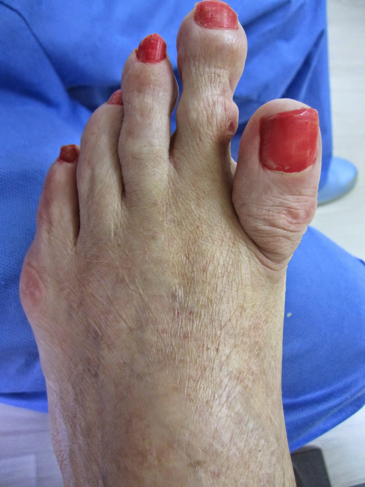 Podo Basas al Día: Heloma en fondo de saco ulcerado. Hallux extensus ...