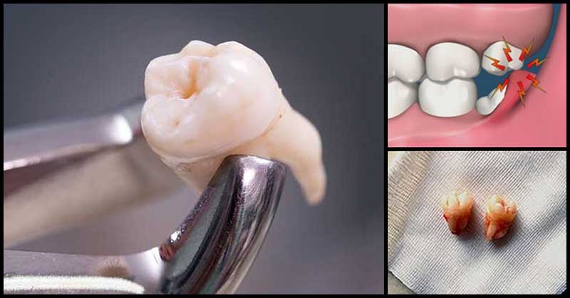 Effective Home Remedies For Wisdom Tooth Pain | Dr Farrah MD