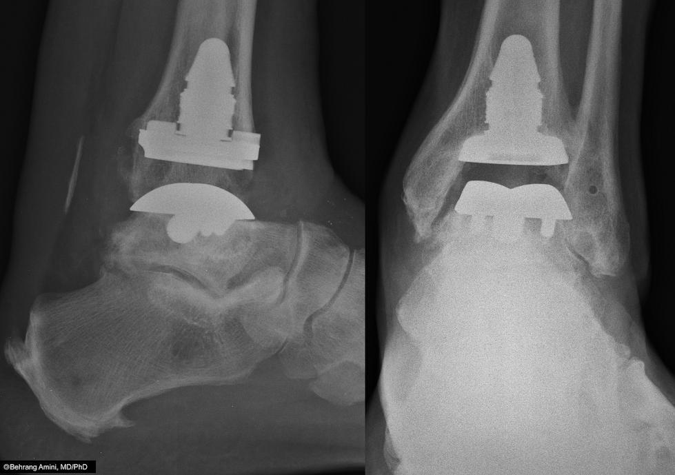 Roentgen Ray Reader: INBONE Total Ankle Arthroplasty