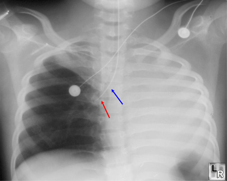 Anesthesia Experiences For The Common Good: Main-stem intubation ...