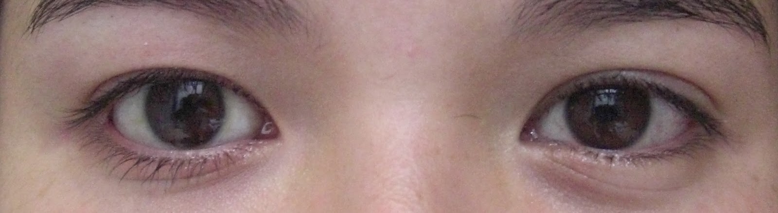 ¿Qué es la Microftalmia?