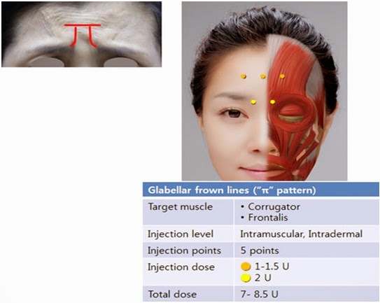 BOTOX EN ENTRECEJO: CÓMO CONSEGUIR UN RESULTADO NATURAL