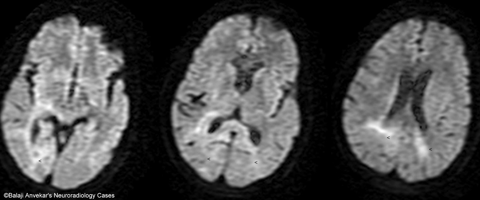 Dr Balaji Anvekar FRCR: HIV Encephalitis Vs PML