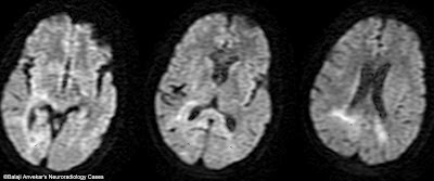 Dr Balaji Anvekar FRCR: HIV Encephalitis Vs PML