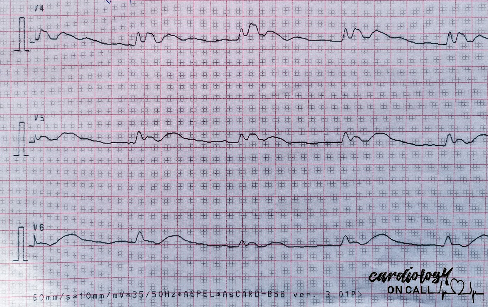 [CASE] 'Shark Fin' sign - true killer among ECG ischemic patterns