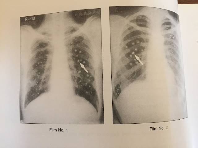 XRAYS OF PULMONARY CALCIFICATION