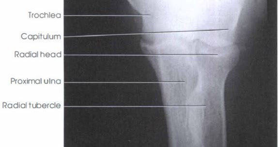 Foreshortened Hand X Ray