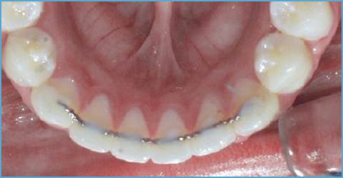 Angolkar Orthodontics Blog: How to Floss Your Fixed Retainer