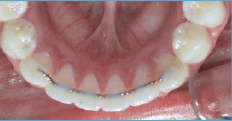 Angolkar Orthodontics Blog: How to Floss Your Fixed Retainer
