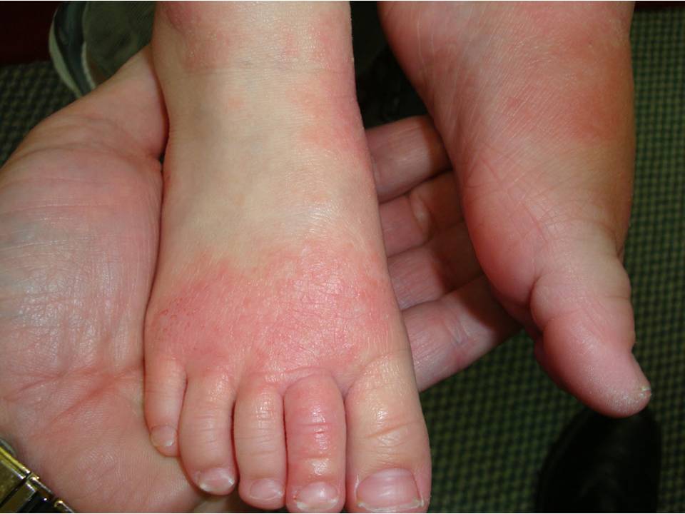 Consultations in Dermatology: The Rash that itches - Atopic Dermatitis