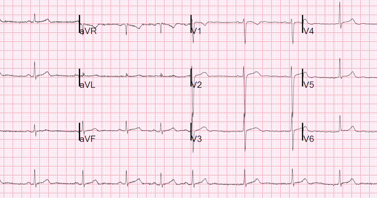 Wandering Atrial Pacemaker Ecg Wandering Atrial Pacemaker FINDINGS: