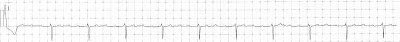 ECG of the Week: ECG of the Week - 1st June 2015 - Interpretation