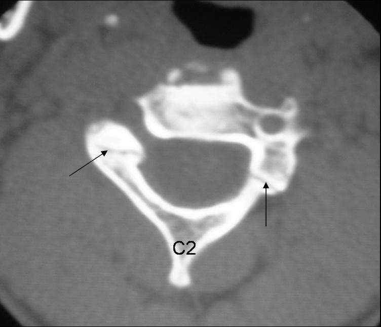 MRI MEDIC CASE STUDIES COLLECTION: Hangman Fracture