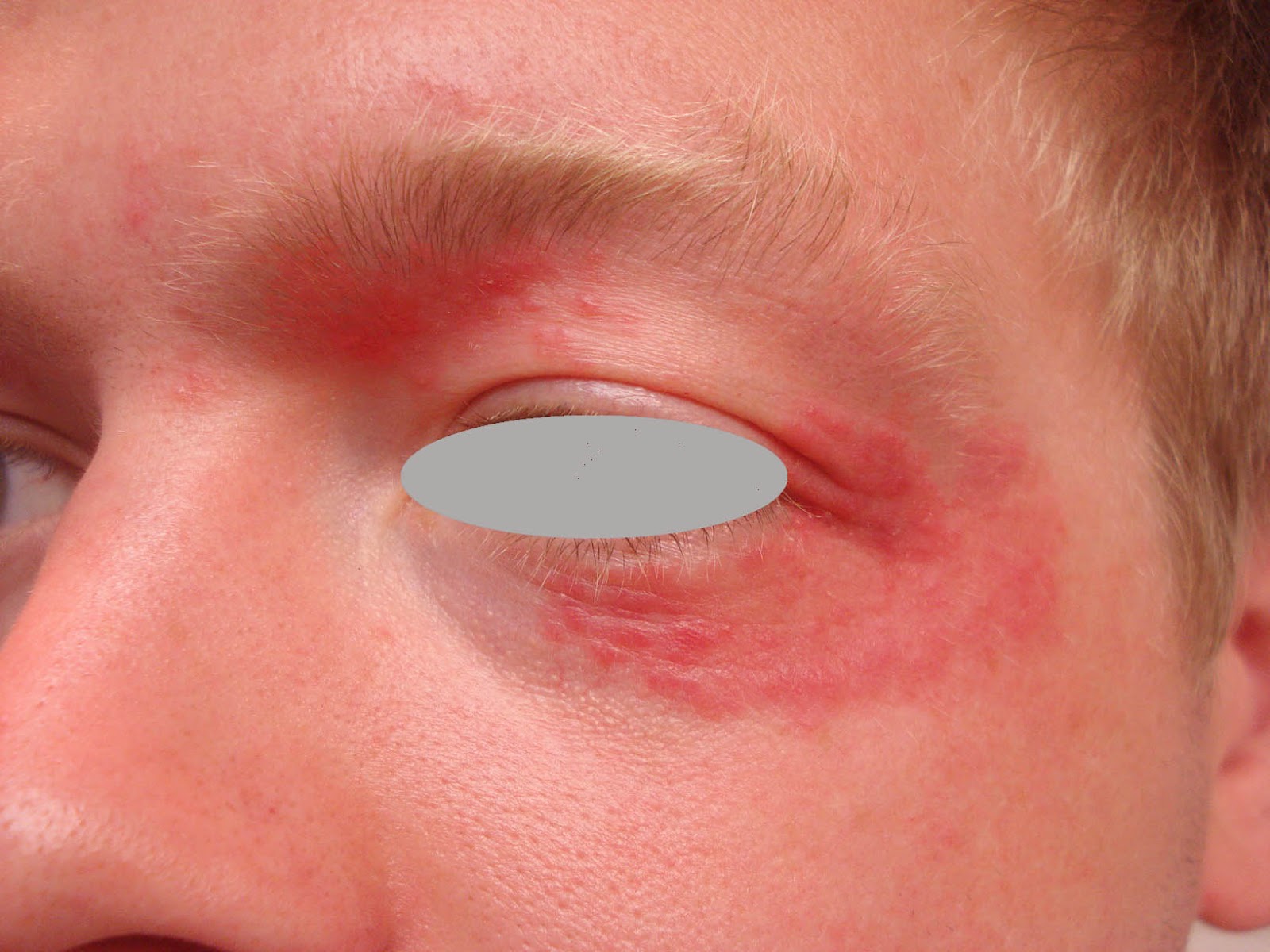 VIRTUAL GRAND ROUNDS IN DERMATOLOGY 2.0: The Tortured Tube