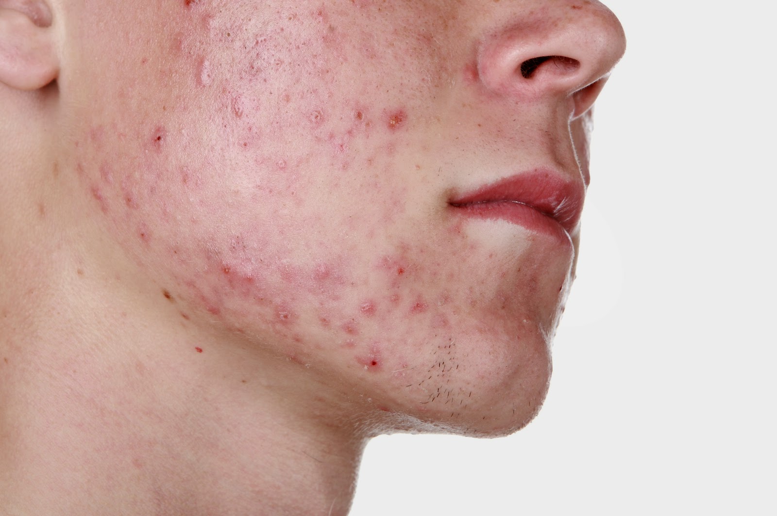SKIN DISEASE TYPES: Acne Skin Disease (Skin Disease Type)