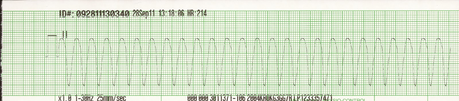 ACLS review: Pulseless VF/VT Part 1