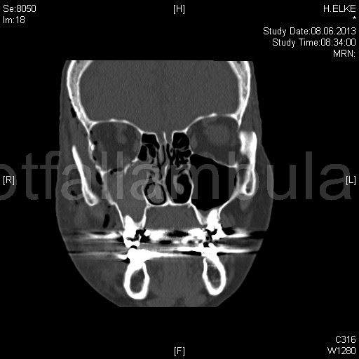 Brennpunkt Notaufnahme: Fall 8 Auflösung: Orbitabodenfraktur