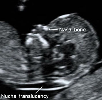 Lil' peanut of us: Week 13 - Nuchal scan