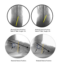 GraMedica®: Indications for the HyProCure® Procedure