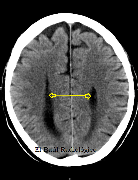 El Baúl Radiológico: DISGENESIA DEL CUERPO CALLOSO: HALLAZGOS EN TC e ...