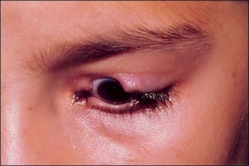 20/20 EYE GLASSES: Coloboma