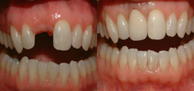 Amazing Discovery: Goodbye Dental Implants, Here’s How to Grow Your Own ...