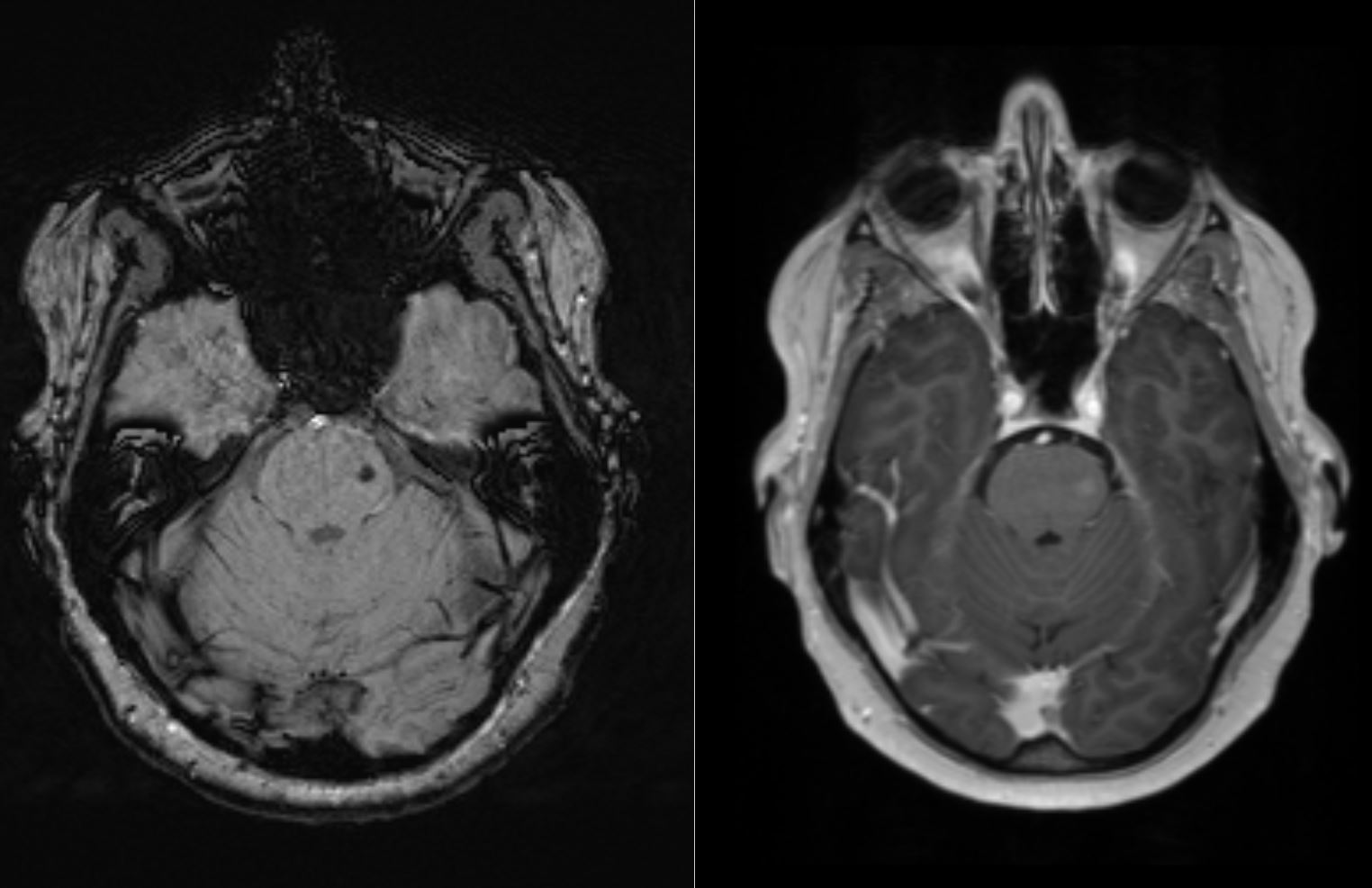 Capillary Telangiectasia