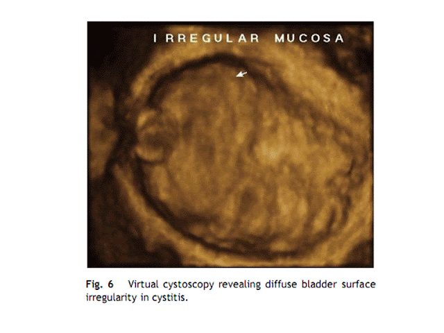 BÀI SOẠN VỀ SIÊU ÂM CHẨN ĐOÁN: VIRTUAL CYSTOSCOPY USING 3D ULTRASOUND