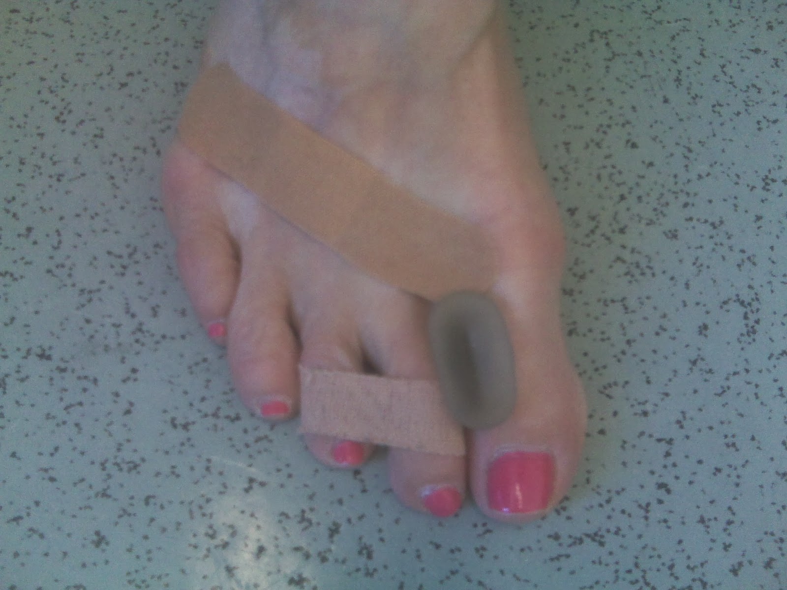 Foot and Ankle Problems By Dr. Richard Blake: Friday's Patient Problem ...