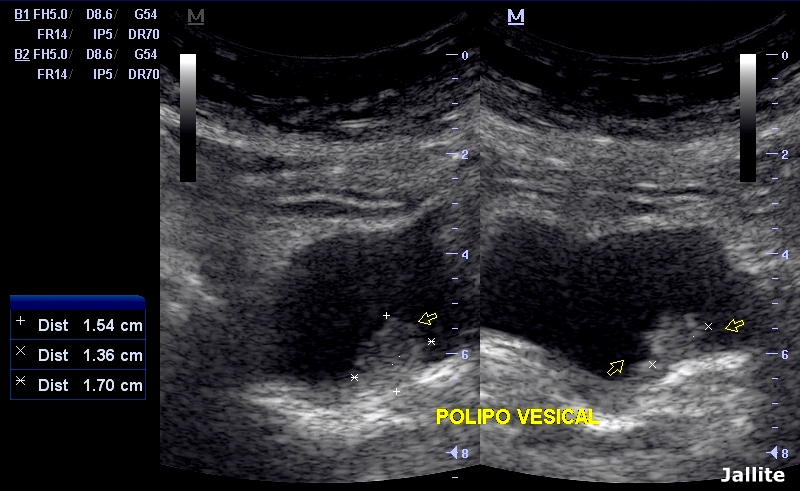 Pólipo Vs Coagulo Vesical