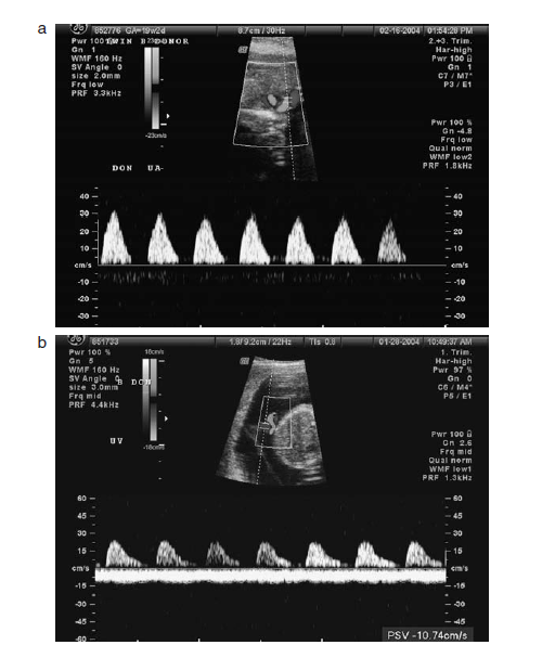 Staging of | Twin-Twin Transfusion Syndrome (TTTS)