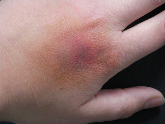 Zoe's How to Blogs: How to do bruise effect make up...