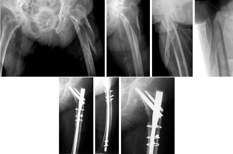 Estimation of bone fracture risk using FRAX® model in some regions of ...