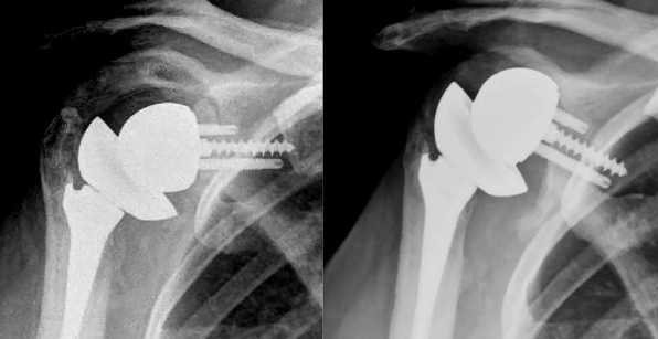 Shoulder Arthritis / Joint Replacement : Reverse total shoulder ...