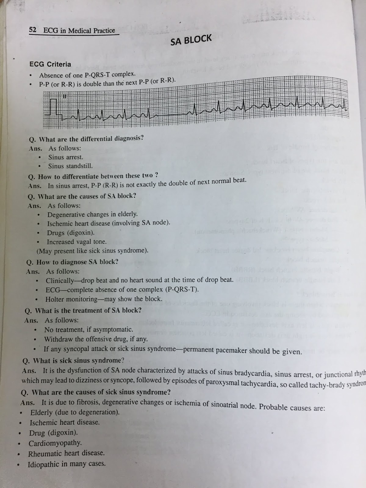 ECG IN HEART BLOCK-SA BLOCK