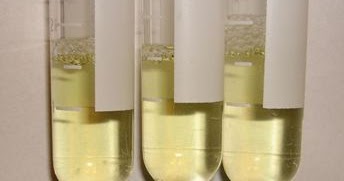 Xanthochromia CSF Definition, Test, Timing, Guidelines, Interpretation ...