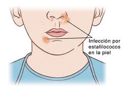 Entrenamiento Capacitación Medica Prehospitalaria: ¿Qué es una ...