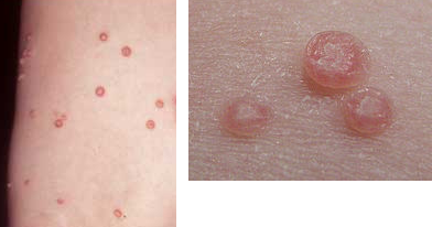 Osip i promjene na koži kod djece - Foto-vodič: Moluske (vodene bradavice)