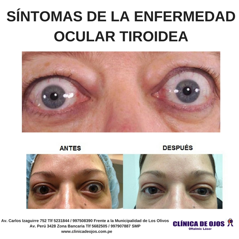 Síntomas de la enfermedad ocular tiroidea
