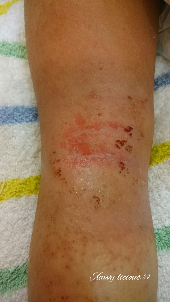 xavvy-licious: 3rd Eczema Flare - Bloody and Weepy