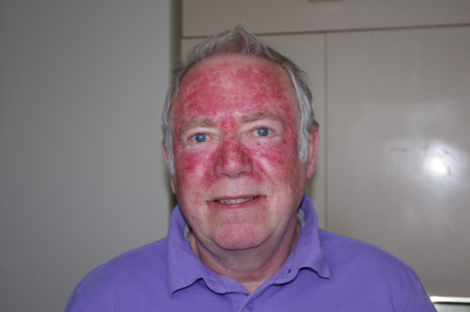 Alan's Efudix/Efudex Experience: May 2012