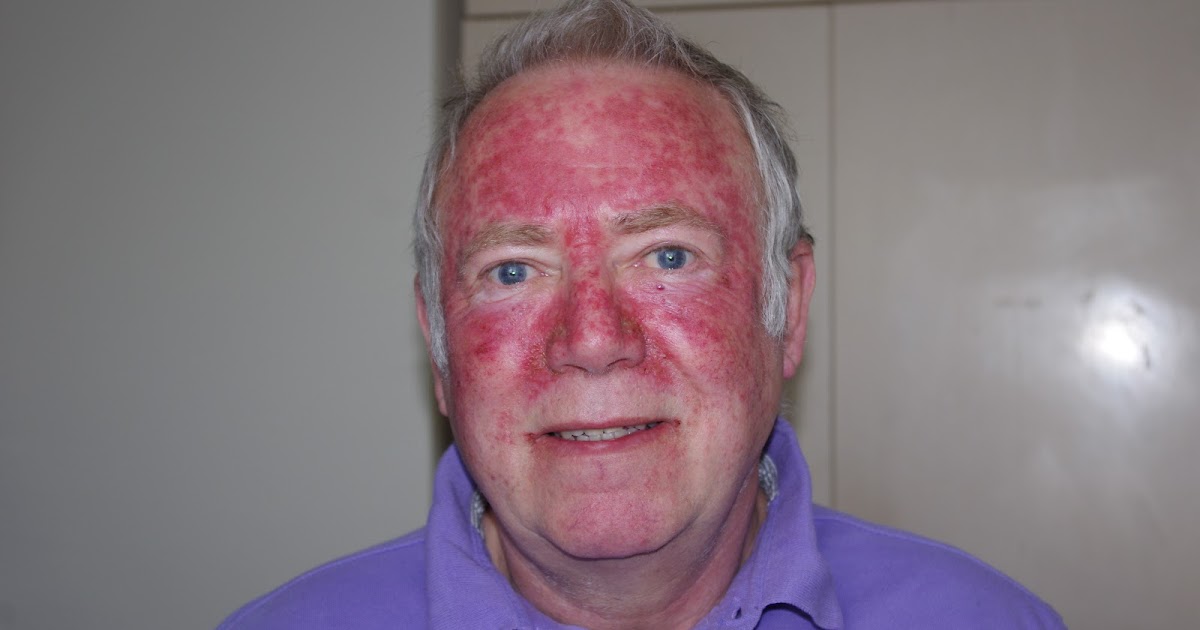 Alan's Efudix/Efudex Experience