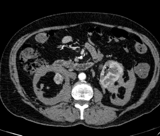 Retroperitoneal Fibrosis limited to Perinephric spaces-Rare Disease ...