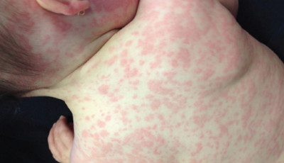 ASK DIS: Maculopapular Rash : Diagnosis