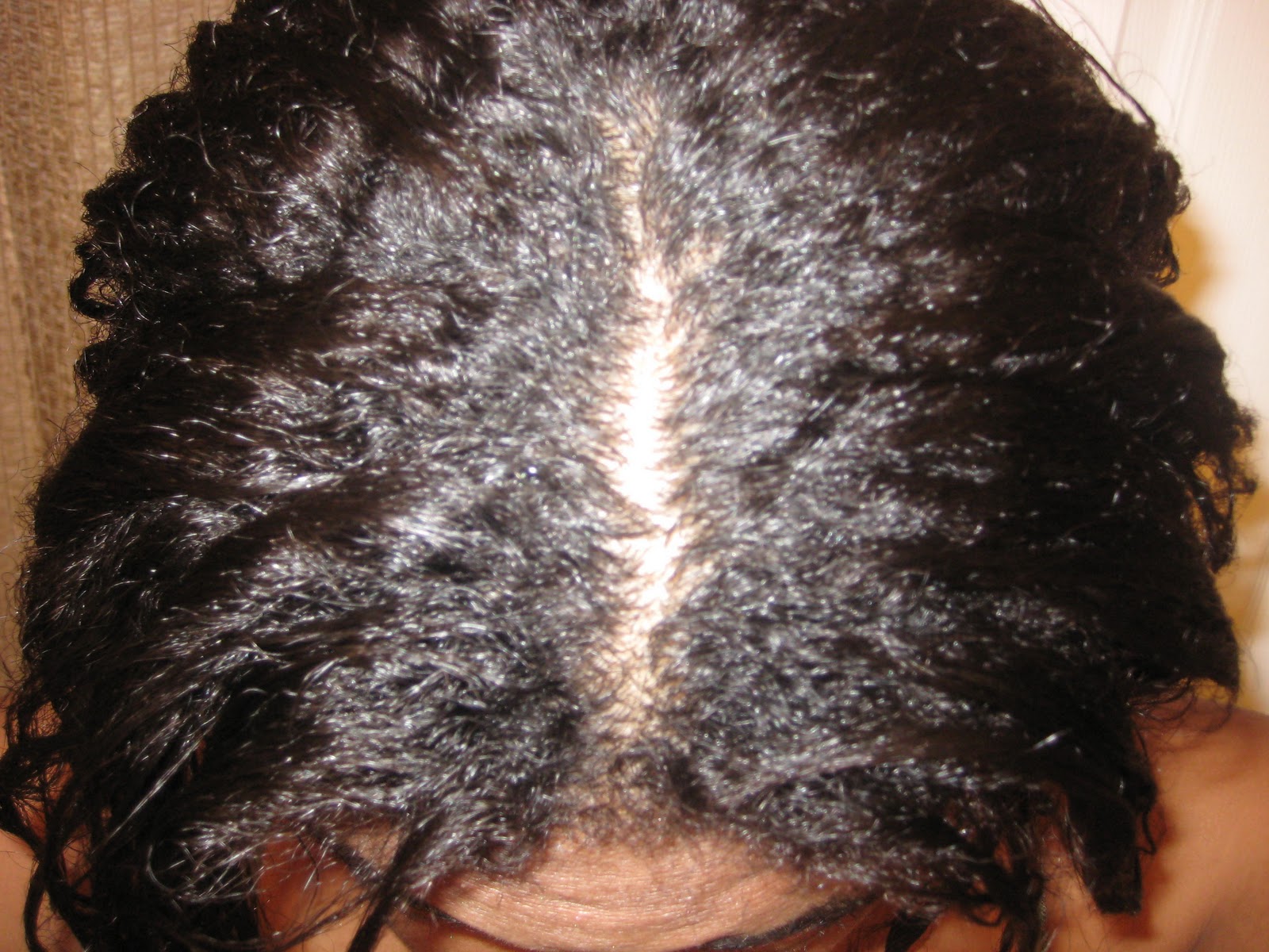 What The Kink?!: Excess Scalp Sebum and Flaking