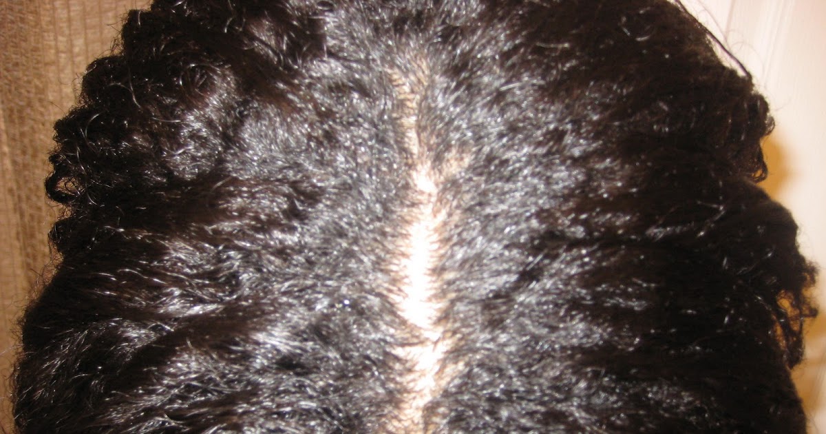 What The Kink?!: Excess Scalp Sebum and Flaking